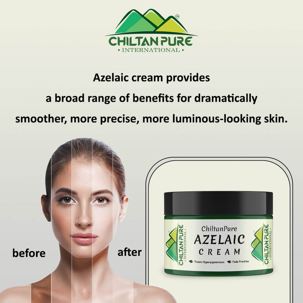Azelaic Cream – Antibacterial, Lighten Freckles, Reduce Hyperpigmentat ...