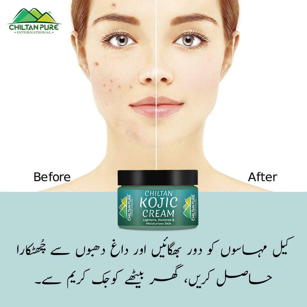 Kojic Cream – Affordable and quality body lotion cream, prevents hyper ...