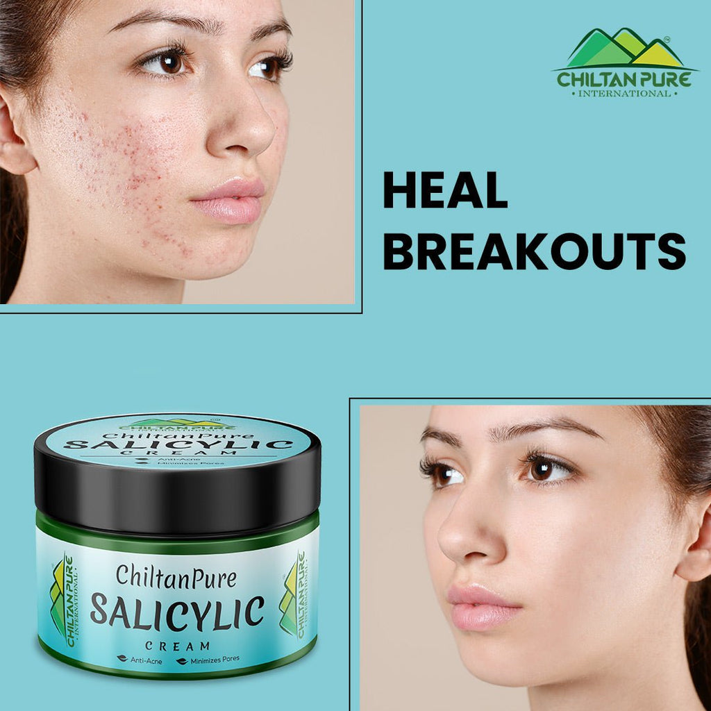 Salicylic Cream – Exfoliates Skin, Anti-Acne, Lighten Acne Scars, Make ...